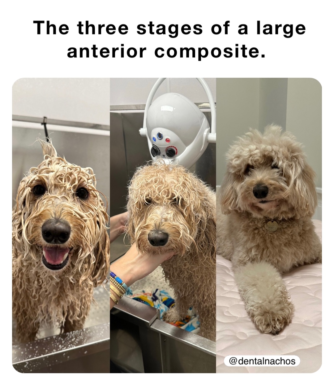The three stages of a large anterior composite. | @paulgoodmandmd | Memes
