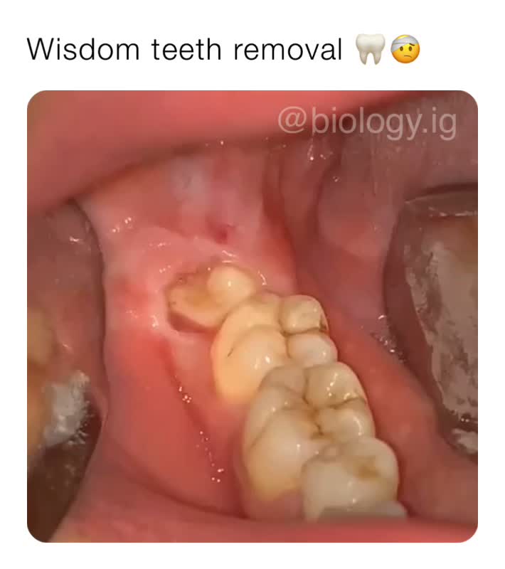 Wisdom teeth removal 🦷🤕 | @Nauloa | Memes